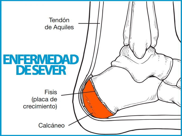 ENFERMEDAD DE SEVER - Cirugia de Columna en Matamoros