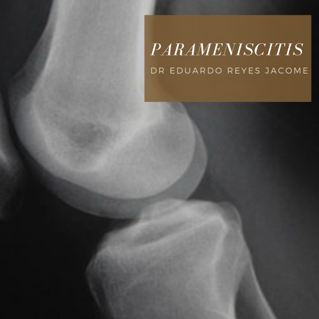 PARAMENISCITIS - Cirugia de Columna en Matamoros