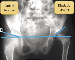 Displasia congénita de la cadera - Cirugia de Columna en Matamoros