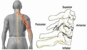 RADICULOPATIA CERVICAL - Cirugia de Columna en Matamoros
