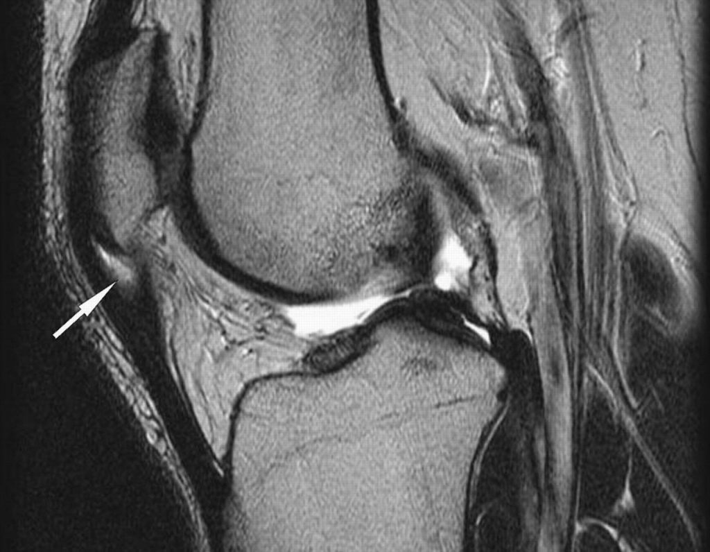TENDINITIS ROTULIANA - Cirugia de Columna en Matamoros