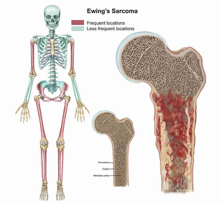 SARCOMA DE EWING - Cirugia de Columna en Matamoros