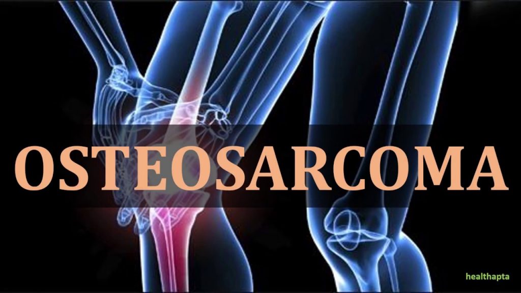OSTEOSARCOMA - Cirugia de Columna en Matamoros