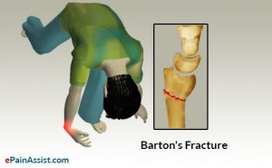 FRACTURA DE BARTON - Cirugia de Columna en Matamoros