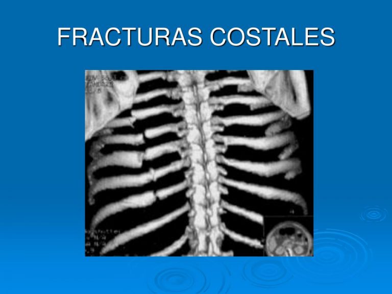 FRACTURA COSTAL - Cirugia de Columna en Matamoros