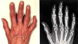 NODULOS DE BOUCHARD - Cirugia de Columna en Matamoros