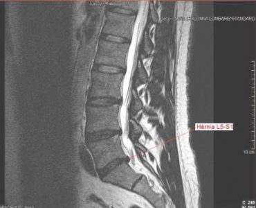 CIATALGIA - Cirugia de Columna en Matamoros