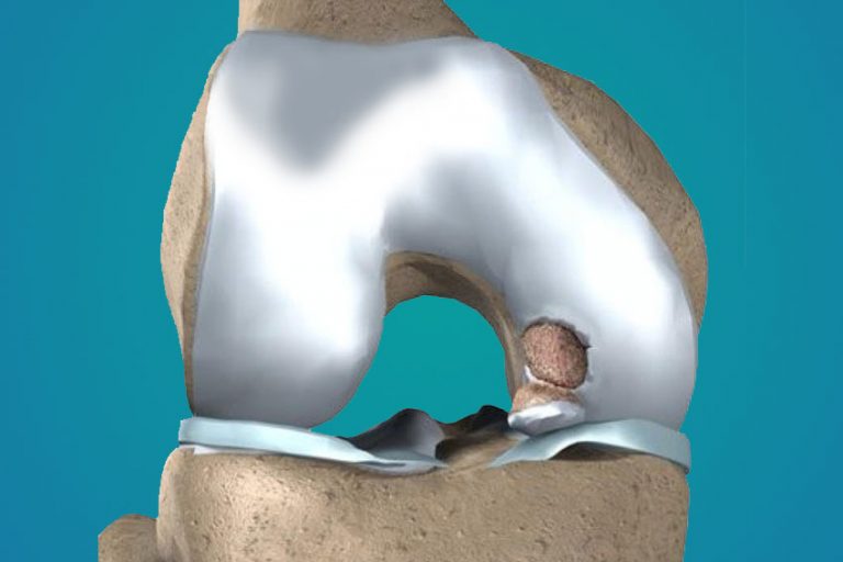 OSTEOCONDRITIS DISECANTE - Cirugia de Columna en Matamoros