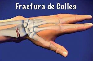 FRACTURA DE COLLES archivos - Cirugia de Columna en Matamoros